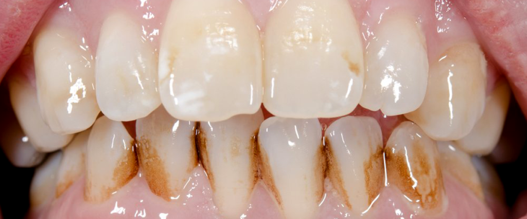 Do You Have Yellow Teeth? Know What Causes It