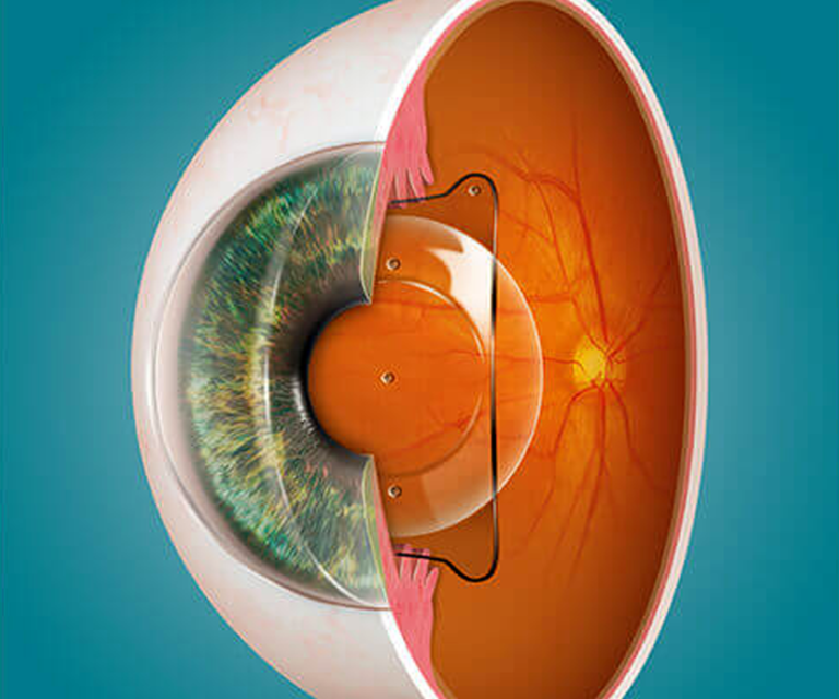 Implantable Contact Lenses | Shinagawa Lasik & Aesthetics